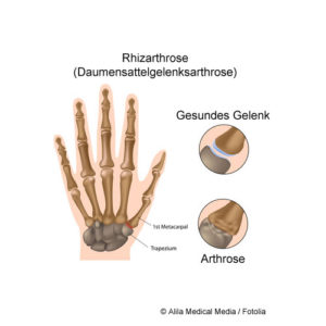 Rhizarthrose: Arthrose des Daumengelenks operieren | Dr. med. Günther ...